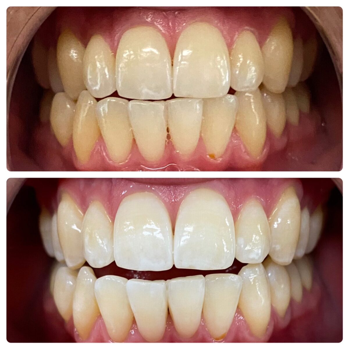 Triple White Teeth Whitening | Teeth Whitening Services