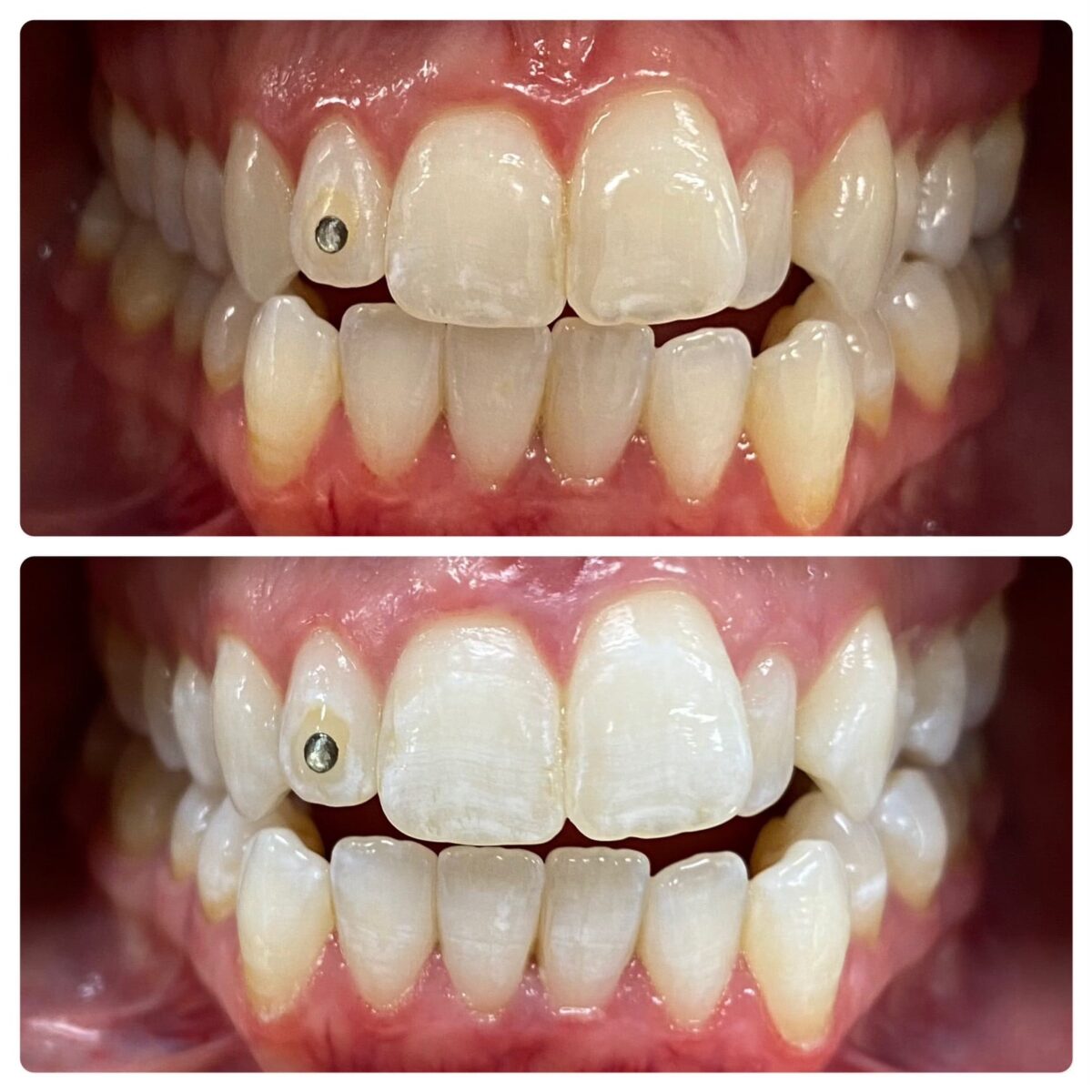 Triple White Teeth Whitening | Teeth Whitening Services