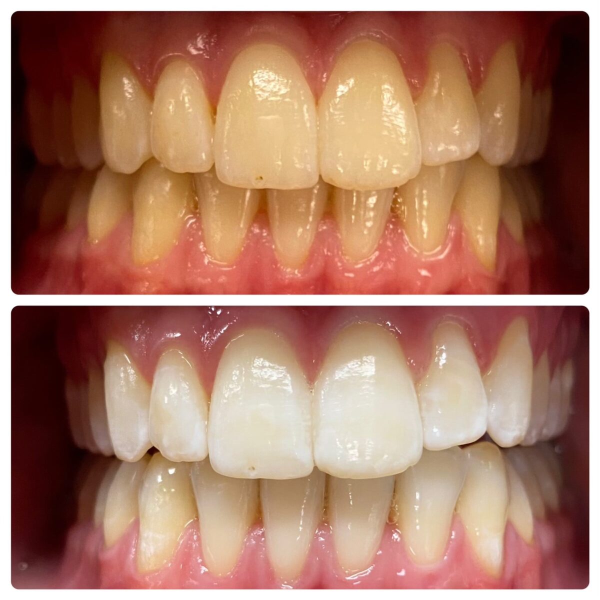 Ultra White Teeth Whitening | Advanced Teeth Whitening