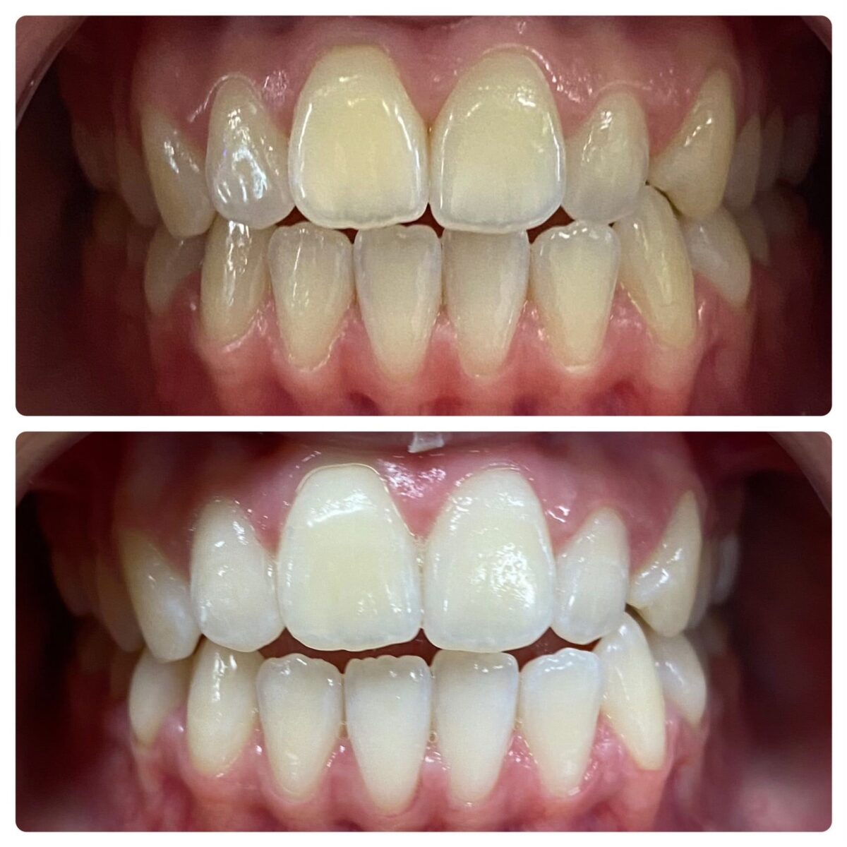 Ultra White Teeth Whitening & Follow up Appointment Package