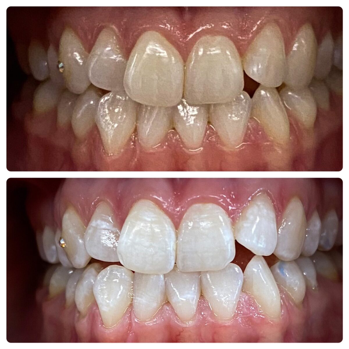 Ultra White Teeth Whitening | Advanced Teeth Whitening
