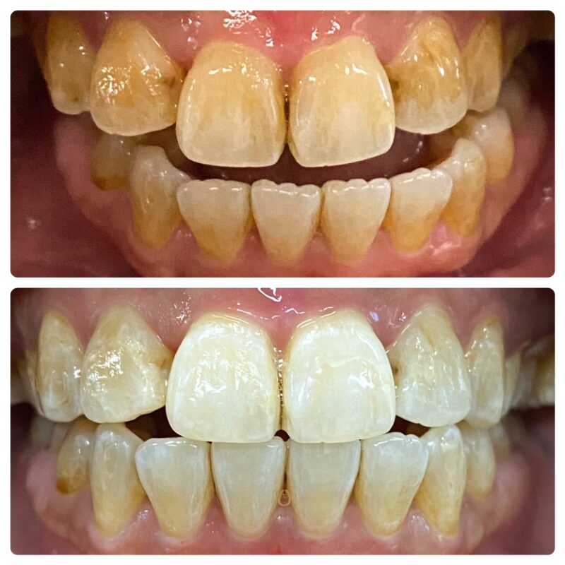 Ultra White Teeth Whitening & Follow up Appointment Package