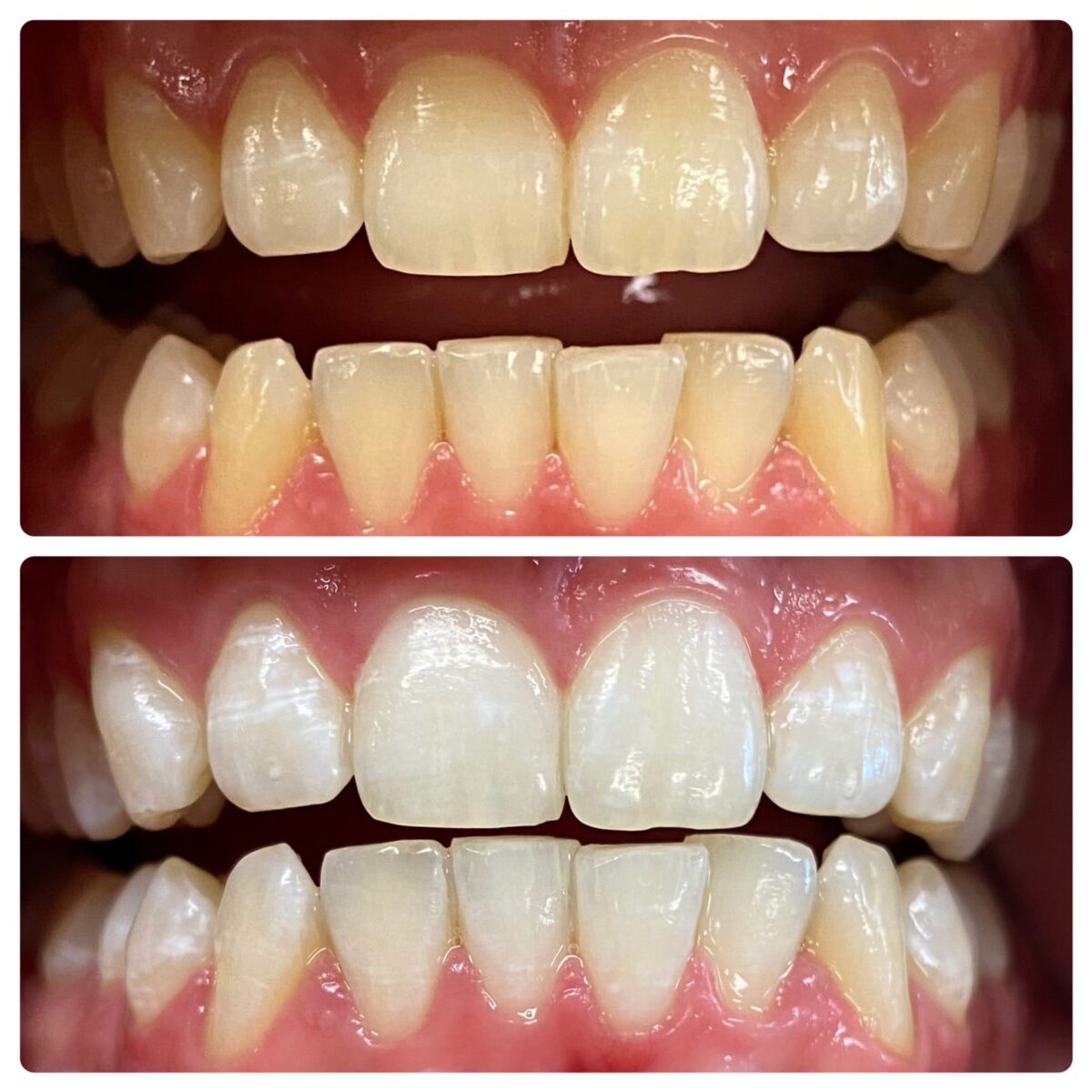 Ultra White Teeth Whitening & Follow up Appointment Package
