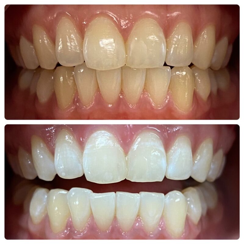 Ultra White Teeth Whitening | Advanced Teeth Whitening