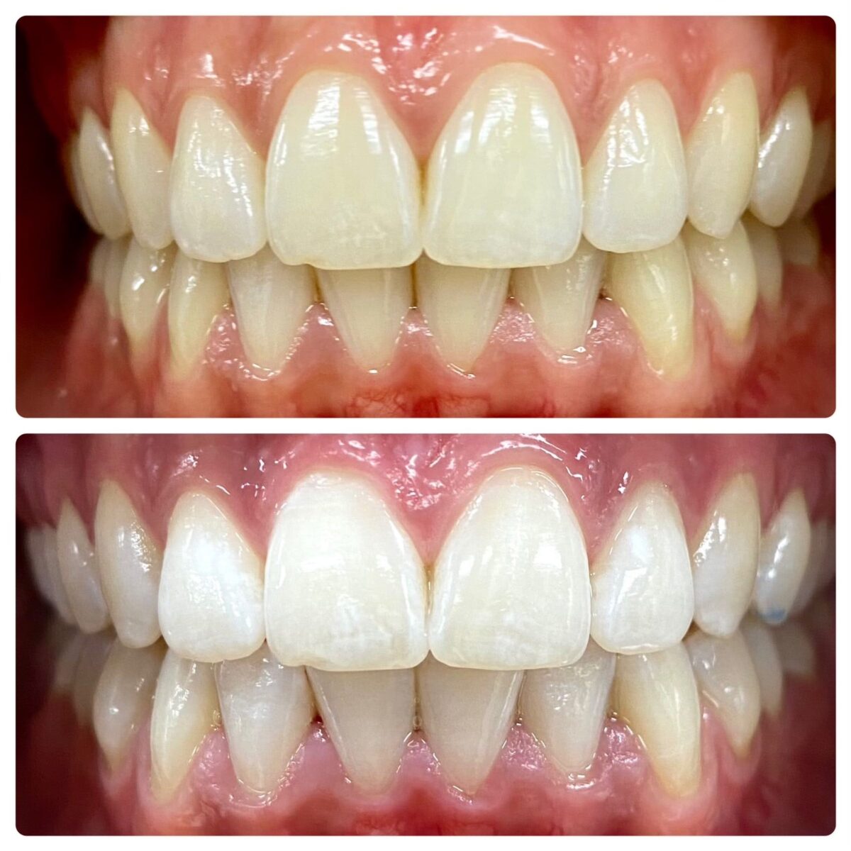 Ultra White Teeth Whitening | Advanced Teeth Whitening